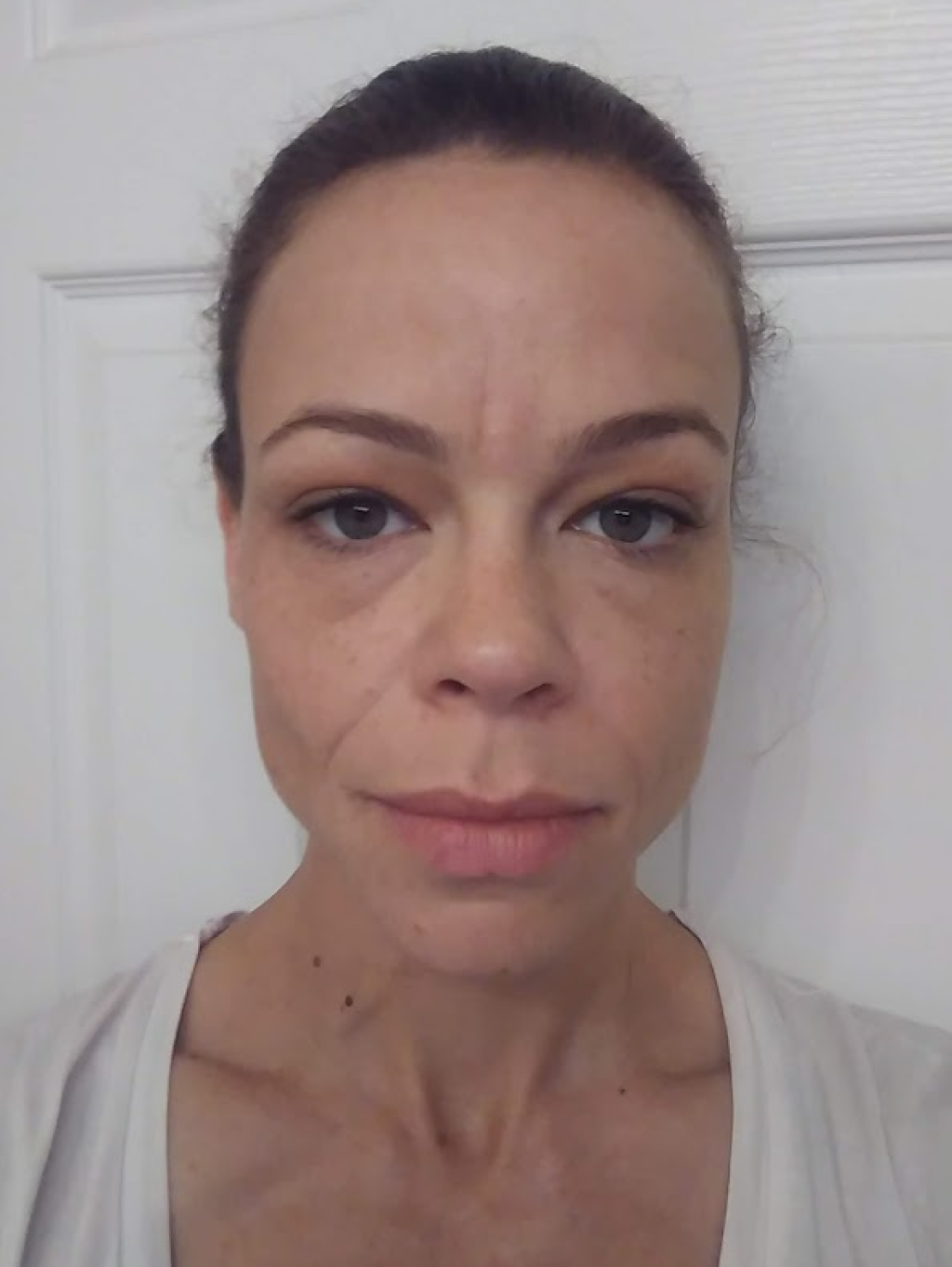 BEVERLY HILLS MD DEEP WRINKLE FILLER REVIEWS: EVERYTHING YOU NEED TO KNOW